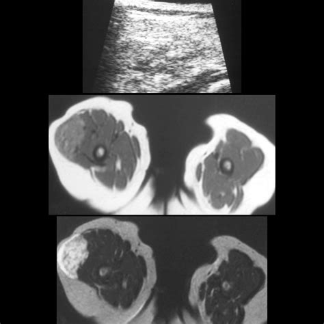 Pediatric Angiolipoma Pediatric Radiology Reference Article