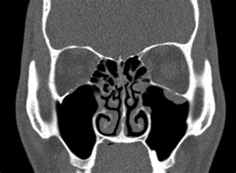I Just Have My Sinus Ct Scan Can Anyone Help Me Interpret Anything
