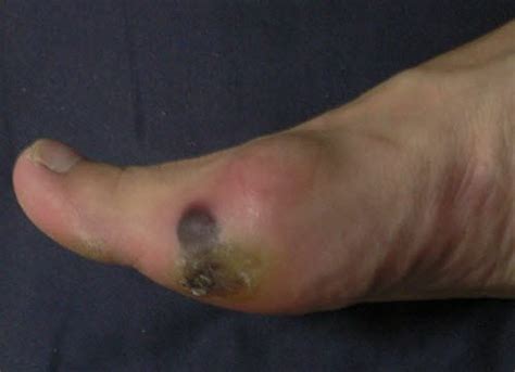 Blood Blister On Foot Blood Blister On Toe Causes And Treatment