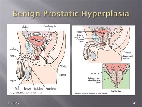 Benign Prostatic Hyperplasia Ppt