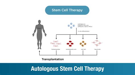 What Is An Autologous Cell Transplant Plexus