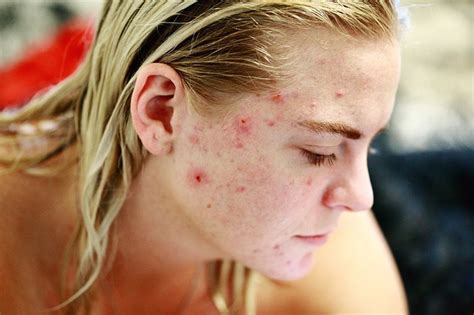 Dermal Fillers For Acne Scars Your Complete Guide