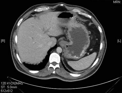 Axial Abdominal Computed Tomography With Contrast Shows Moderately Download Scientific Diagram