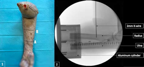 1 A Marks The Planned Location Of Osteotomy B Marks The Planned