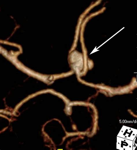 Anterior Communicating Artery Acoa Aneurysm A Cerebal Computed Download Scientific Diagram