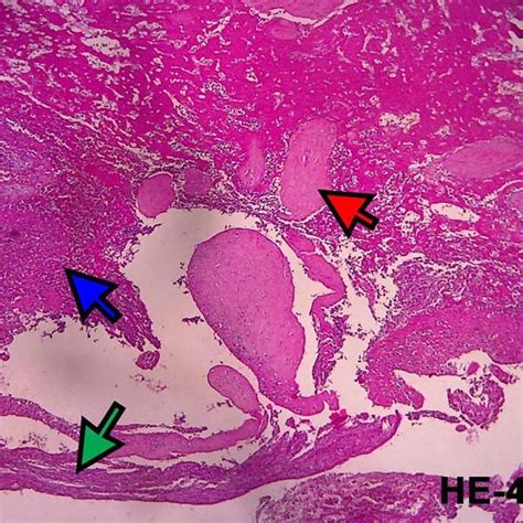 The Gross Specimen Showing A Cesarean Scar Pregnancy Download Scientific Diagram