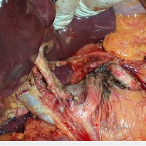 Intraoperative Appearance After Hepatoduodenal And Celiac Lymph Node