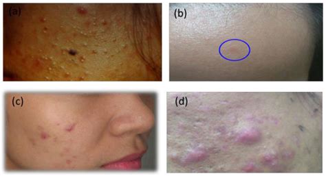 Clinical Features Of Acne Vulgaris A Acne Type 1 Lesion B Acne
