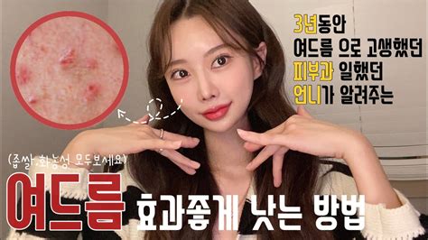 지금은 꿀피부 유지중 좁쌀부터 화농성까지 3년동안 안해본 관리가 없는피부과일했던언니가알려주는여없애는 법 좁쌀화농성프락셀여드름흉터레이저스팟크림여드름꿀팁알라딘박피