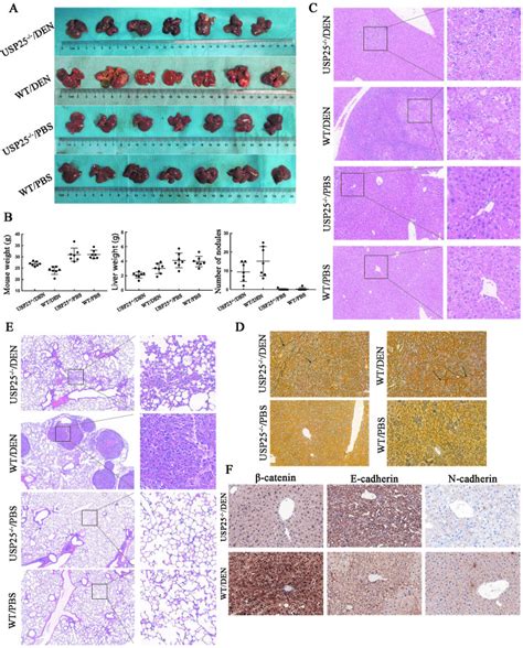 Usp25 Promotes Hepatocellular Carcinoma Progression By Interacting With