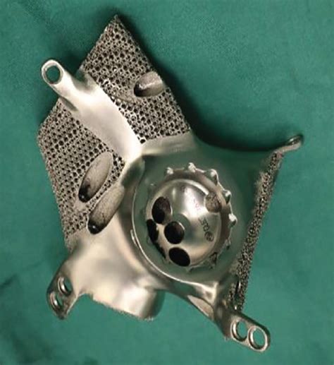 The 3d Printed Pelvic Prosthesis A Lateral View Of A Prosthesis