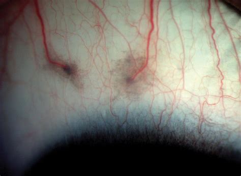 Variations In Appearance Of The Normal Eye Clinical Tree