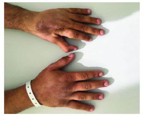 Both Hands Extended Long On A Surface Shortening In The Second Left Download Scientific