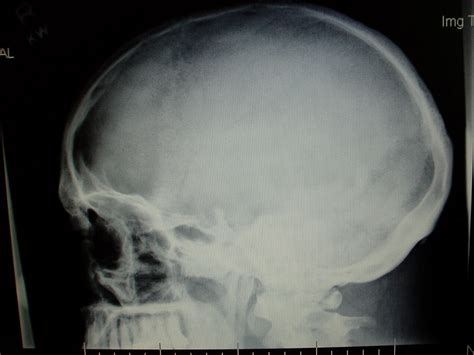 Albers Schonberg Disease Eurorad