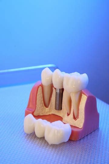 Dental Implant Model Plate Denture Dental Implant Artificial Tooth