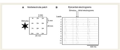 Epicardial Mapping A Multielectrode Array Used To Record Bipolar Download Scientific Diagram
