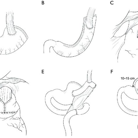 Reconstruction Of The Digestive Tract After A Proximal Gastrectomy A Download Scientific