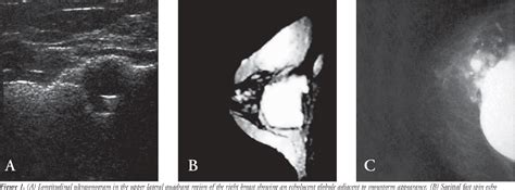Figure 1 From Evaluation Of The Rupture Of Silicone Breast Implants By