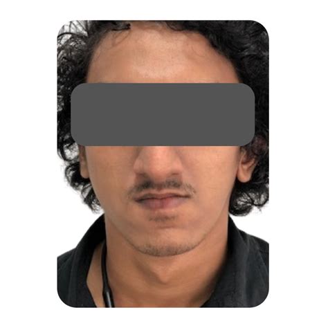 Class Iii Dental Cases Treatment Vallamattomorthodontics