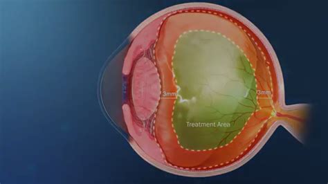 Yag Laser Vitreolysis For Vitreous Floaters Tanner Eyes