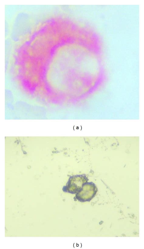 Differential Expression Of Matrix Metalloproteinase 2 Expression In Disseminated Tumor Cells And