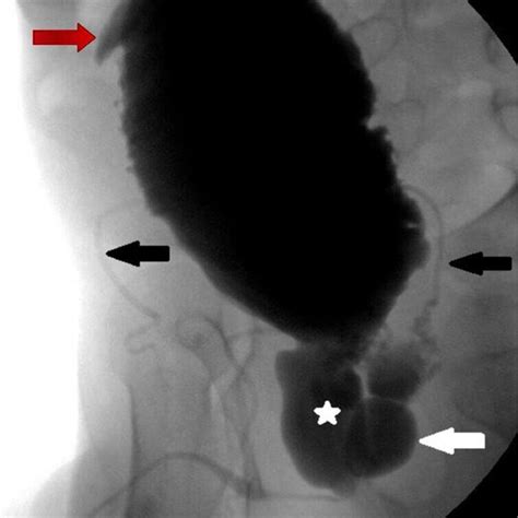 Late Presentation Of Posterior Urethral Valve With Giant Prostatic