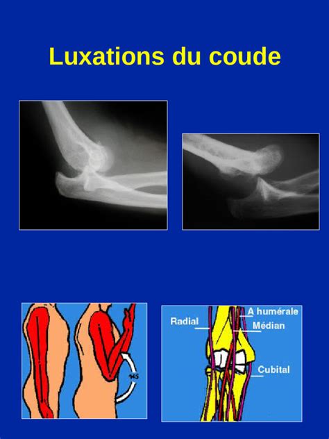 10 Coude Luxation Fract Olecrane Radius Pdf