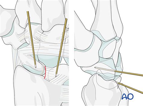 Open Reduction Ligament Repair For Lunate Dislocation