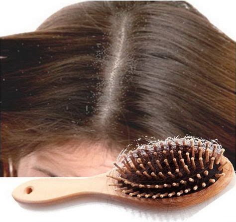 Effective Ways To Stop Dandruff And Have Healthy Scalp