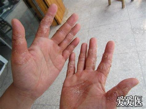 剥脱性皮炎的治疗方法 伤感说说吧