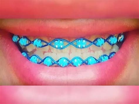 Tipos De Ligas Para Brackets Thetanmapa