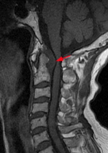 Calcium Pyrophosphate Dihydrate Cppd Crystal Deposition Disease Radsource