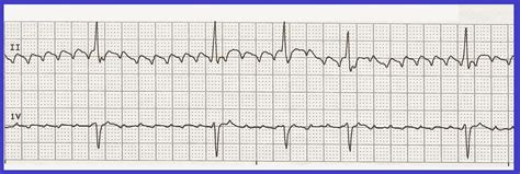 Practice Ekg Rhythm Strips 221