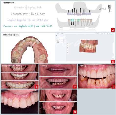 Case Dental Implant Types