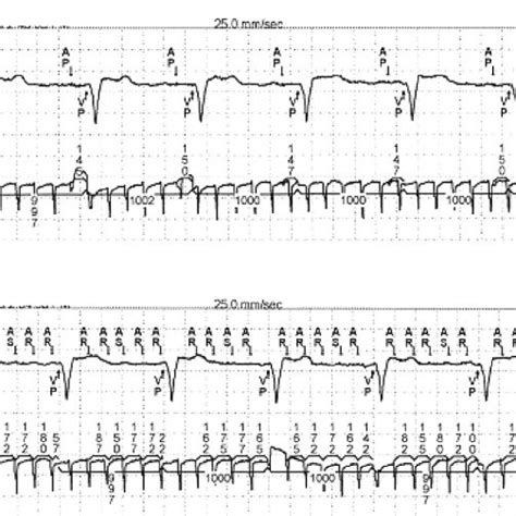 Pdf Paradoxical Undersensing Of Atrial Electrograms During Atrial Fibrillation Due To Repeated