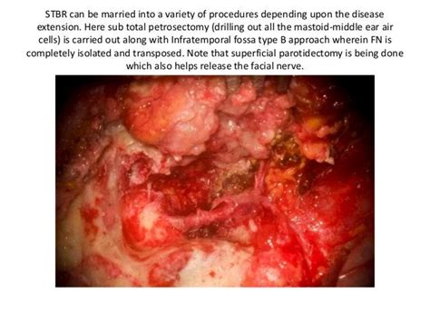 Temporal Bone Resection Ppt