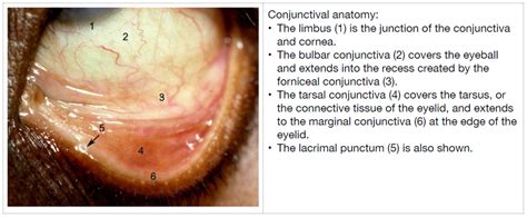 Conjunctival Pearls Brown Med Peds