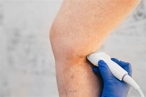 Varicose Veins During Pregnancy A Common Condition Explained