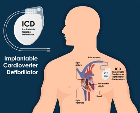 What Is A Pacemaker And Its Types Dr Atul Kasliwals Blog
