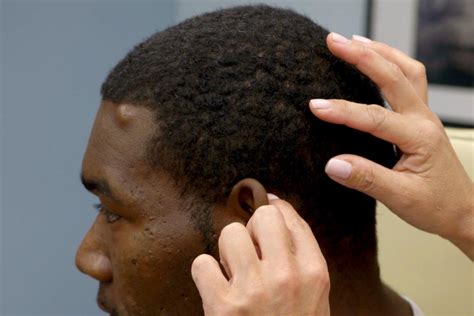 Dr Pimple Poppers Top Pops Before And After Photos