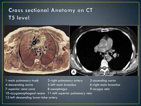 Ppt Imaging Anatomy Of The Mediastinum Powerpoint Presentation Free