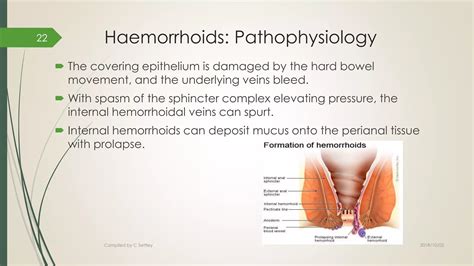 Constipation And Appendicitis Ppt Free Download