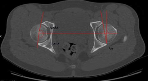 Figure 1 From Imaging Hip Dysplasia In The Skeletally Mature