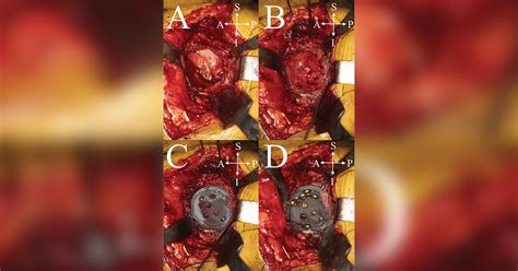 78 Year Old Man With Acetabular Bone Defect After Tha