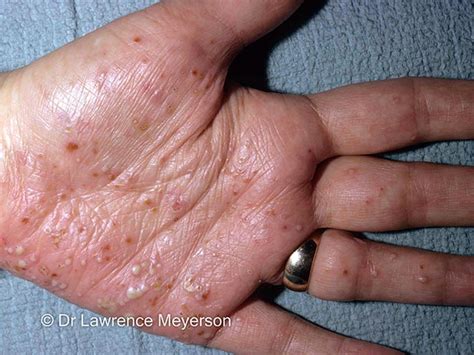 Palmoplantar Pustular Psoriasis Dtwnir