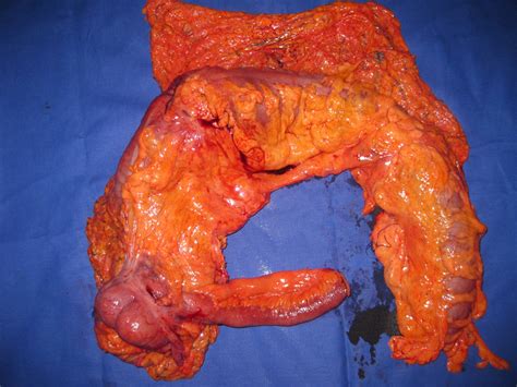 Subtotal Colectomy Doccheck