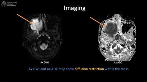 17 Year Old Female Presented With Suspected Dental Hematoma Or Abscess