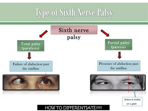 Sixth Nerve Palsy Ppt