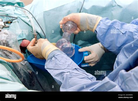 Bladder Cancer Surgery Surgeon Performing A Transurethral Resection Of A Bladder Tumour Turbt