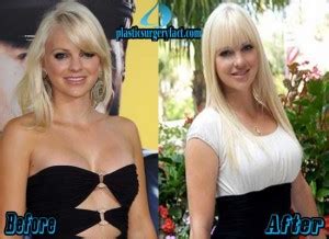 Anna Faris Plastic Surgery Before And After Photos